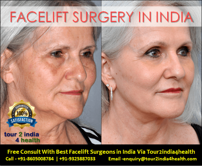 Face lift surgery in Tehuac | A Listly List