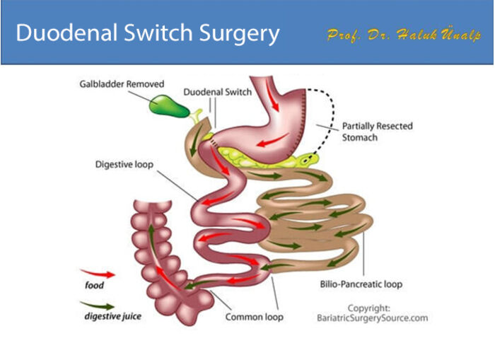 Duodenal Switch surgery in Coatzacoalcos | A Listly List