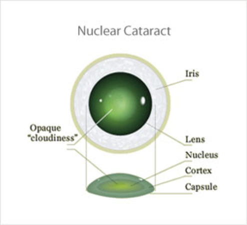 The Three Most Common Types of Cataracts | A Listly List