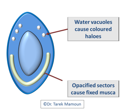 The Three Most Common Types of Cataracts | A Listly List