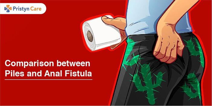 Difference Between Piles And Fistula | A Listly List Difference Between Piles And Fistula | A Listly List