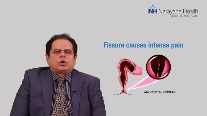 Difference Between Piles Fissure And Fistula | A Listly List Difference Between Piles Fissure And Fistula | A Listly List